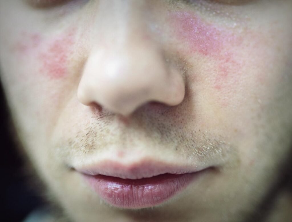 Contact Dermatitis Symptoms: What Sets It Apart?