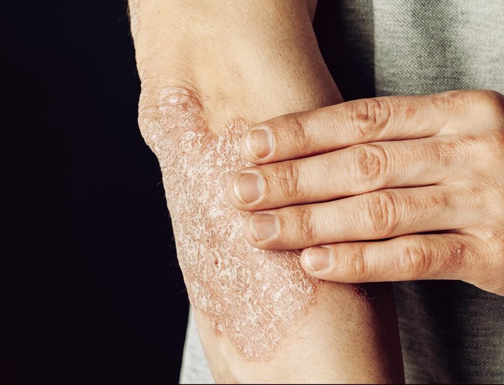 Eczema on Elbows: Spotting Early Symptoms and Prevention